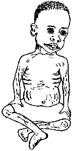 Dr. Deo de Freitas: Marasmo e Kwashiorkor