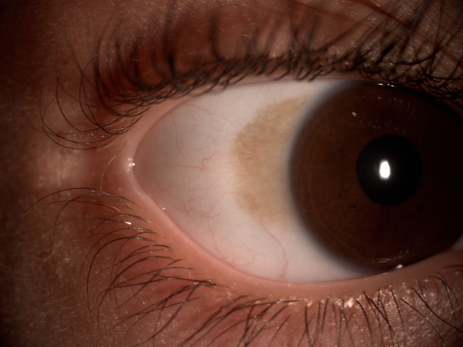 Miranza IOA: MELANOSIS CONJUNTIVAL
