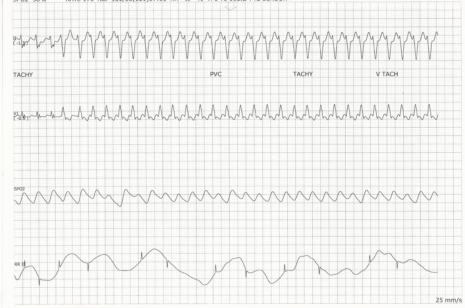 Float Nurse: Wide Complex Tachycardia Changing to VT.