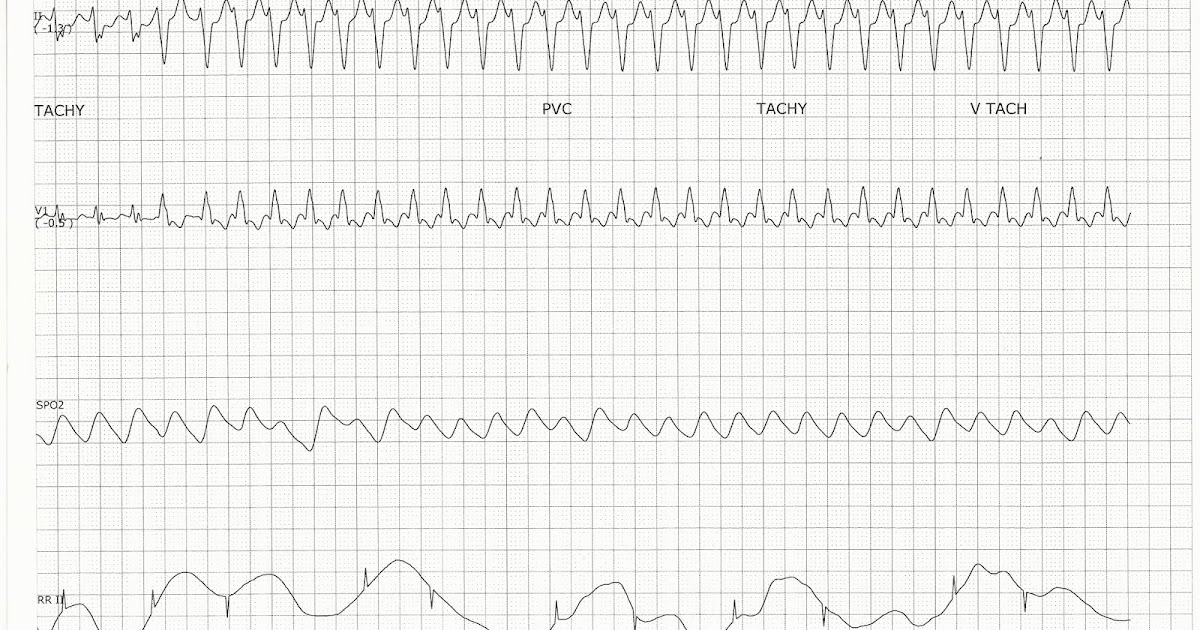 Float Nurse: Wide Complex Tachycardia Changing to VT.