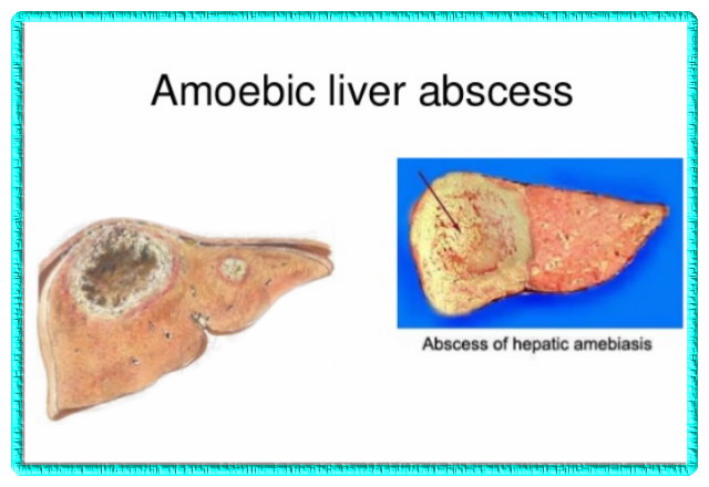 Amoebic liver abscess - Sure Developers Team