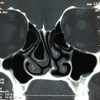 ENT Surgeon's blog: Giant Concha bullosa