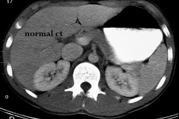 CT abdomen with contrast the suspect multiple hepatic nodules ...