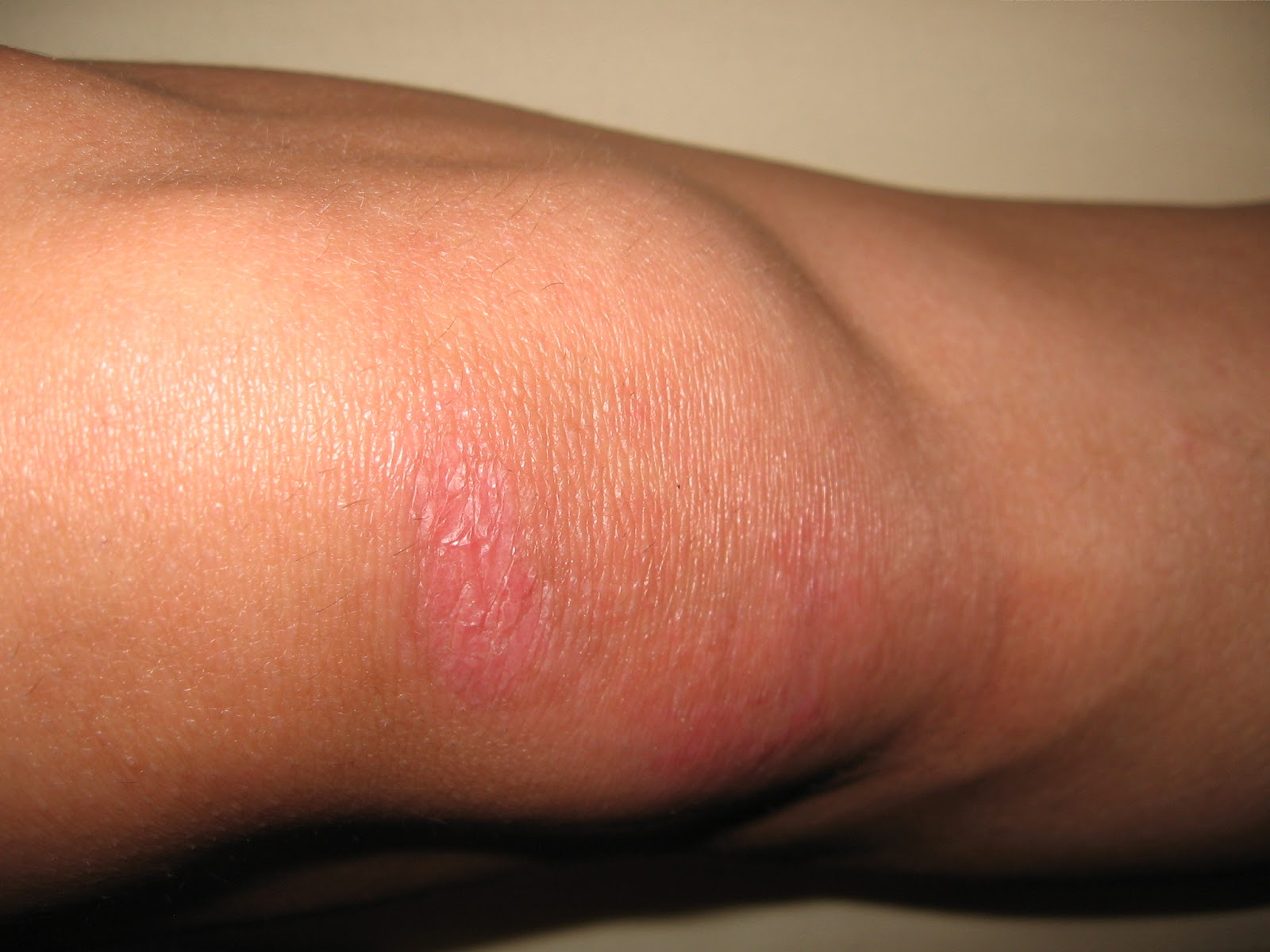 How I complicated my life today: Knee recovery