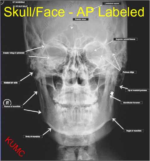 Proyeksi pemeriksaan Cranium | Aditya Radiografer