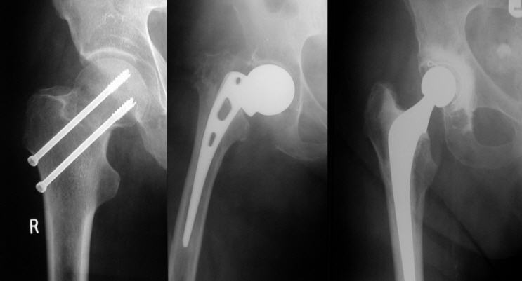 Medical Transcription Open Reduction Internal Fixation