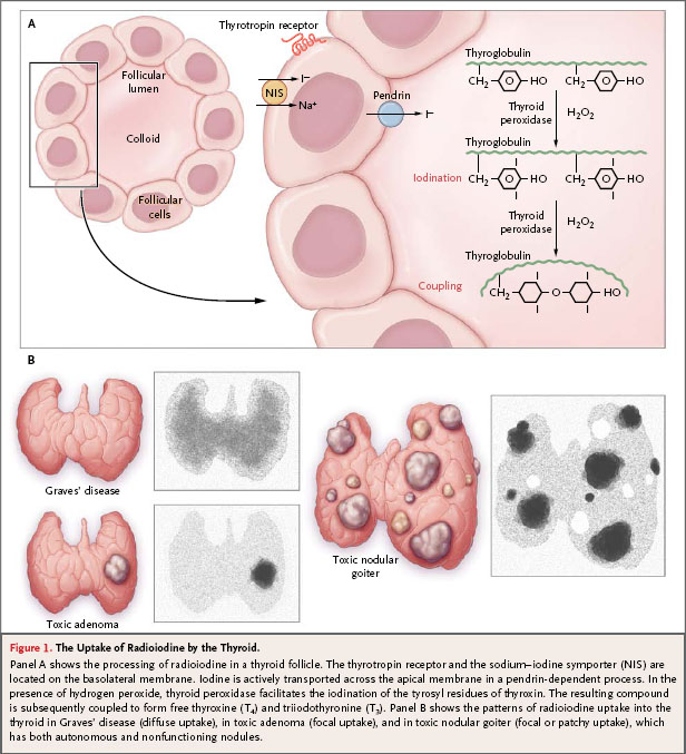 Hyperthyroidism: etiology, pathogenesis, diagnostic criteria, treatment ...
