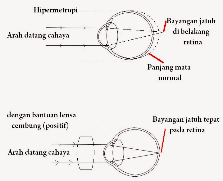 nurse: Koreksi Miopi, Hipermetropi, dan Presbiopi