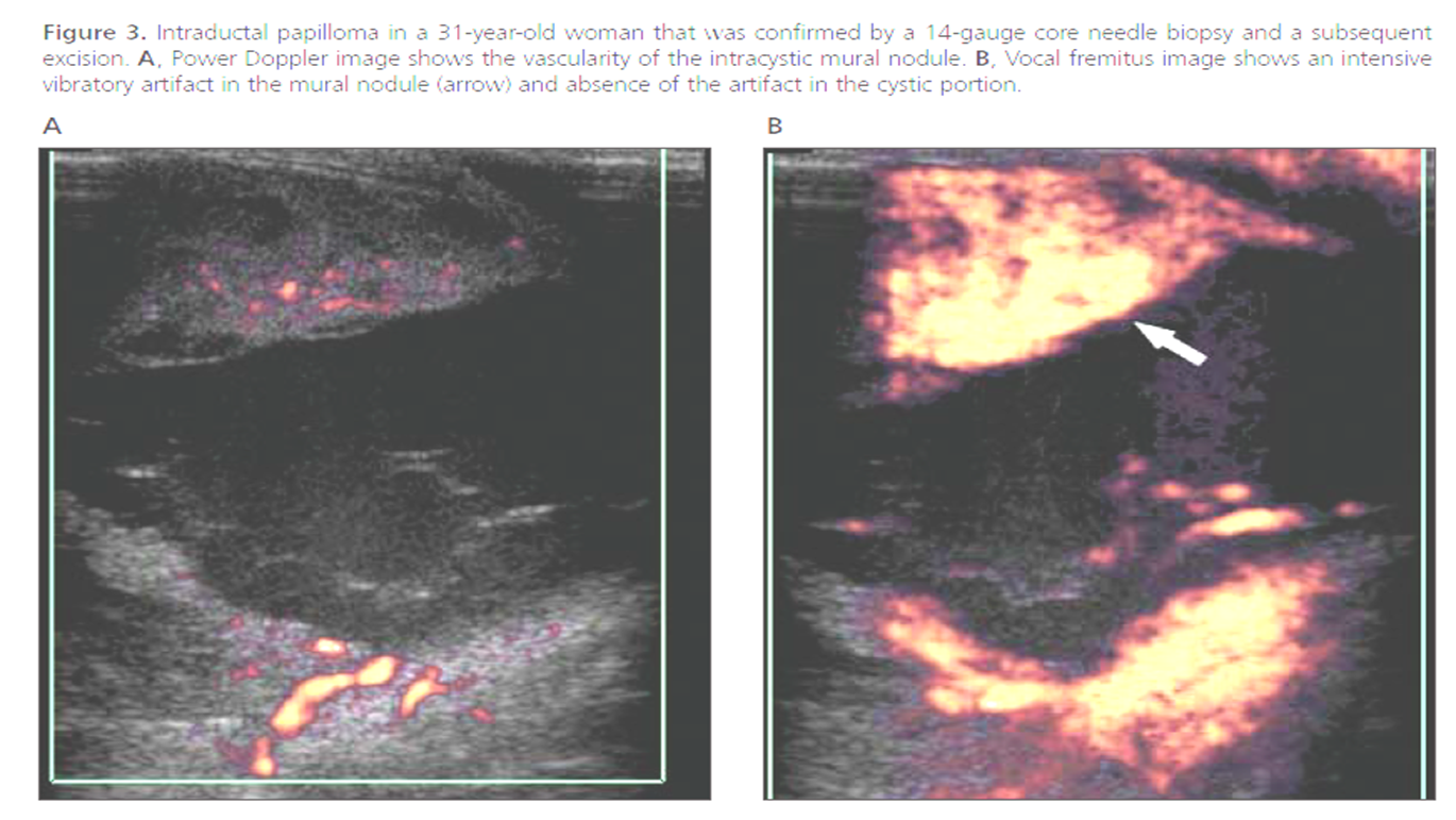 BÀI SOẠN VỀ SIÊU ÂM CHẨN ĐOÁN: VOCAL FREMITUS in BREAST COLOR ...