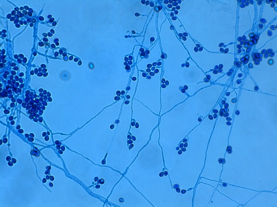 Fun With Microbiology (What's Buggin' You?): Scedosporium prolificans