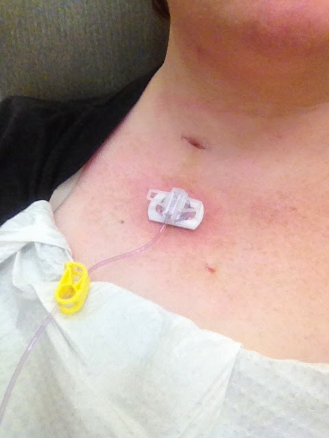 Beating Bob - Allie's Hodgkin's lymphoma journey: Staging, chemo 1, and ...