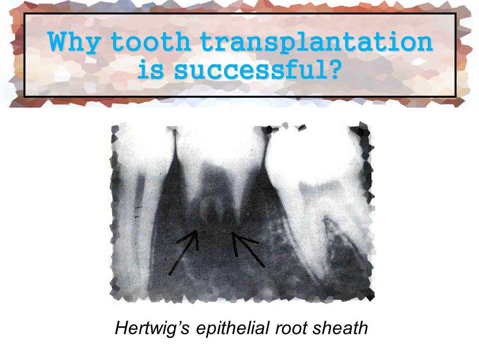 Dentistry: Tooth Transplantation