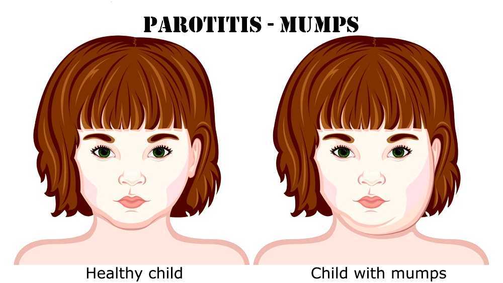Parotitis