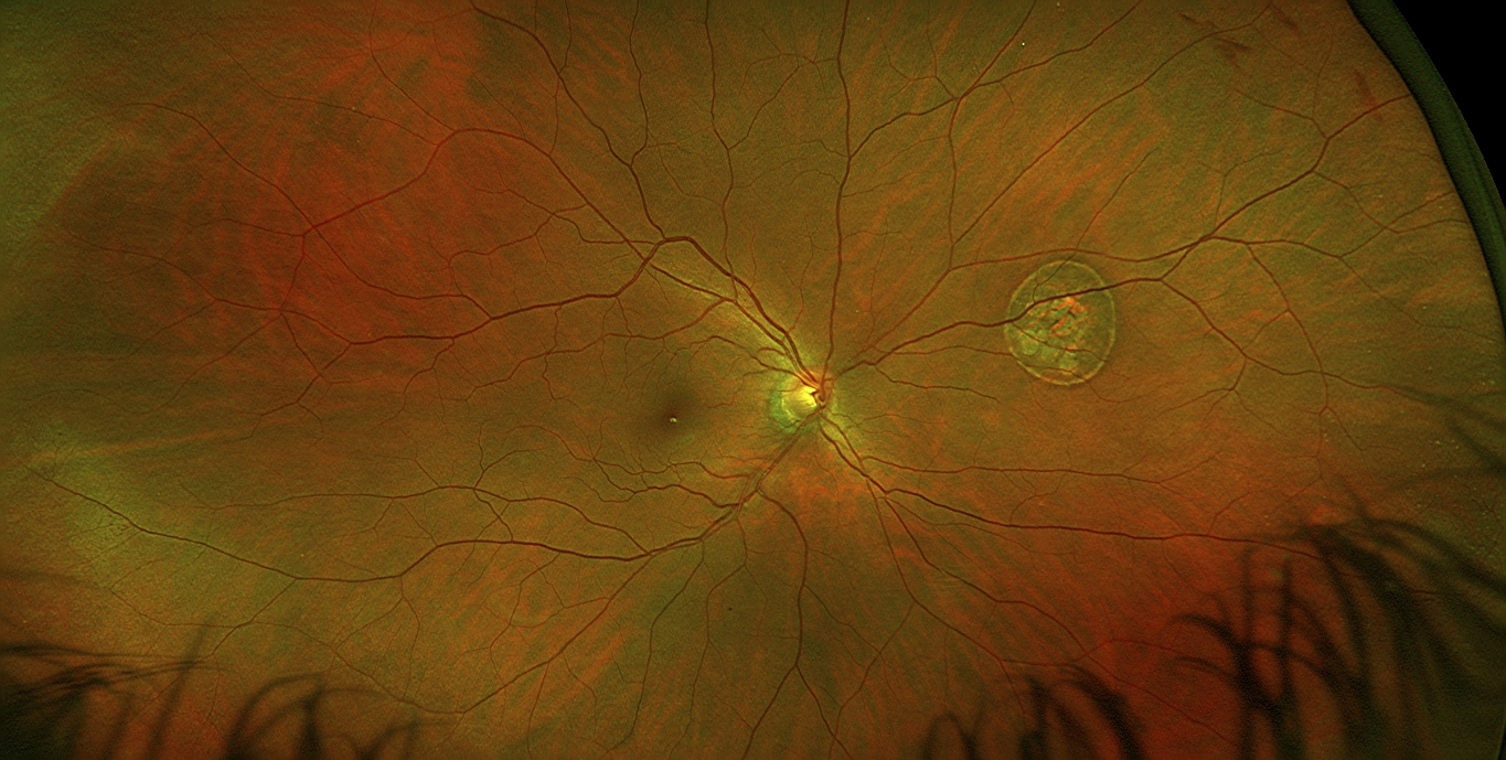 Sonoran Desert Eye Center: CONGENITAL HYPERTROPHY OF THE RETINAL ...