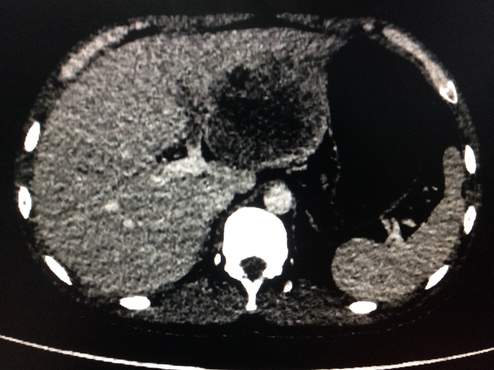 VIETNAMESE MEDIC ULTRASOUND: CASE 407: LIVER INFARCTION, Dr PHAN THANH ...