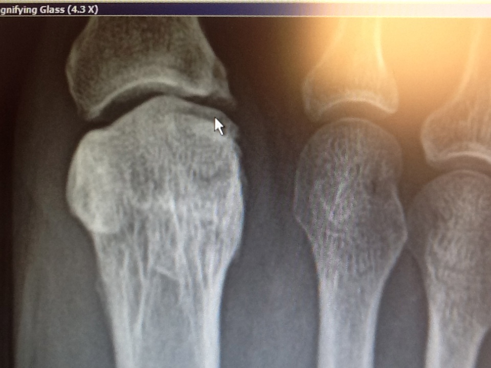 Foot and Ankle Problems By Dr. Richard Blake: Bunion or Arthritis: An ...