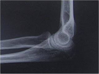 rayos x 2011: CODO Proyección Lateral LATEROMEDIAL