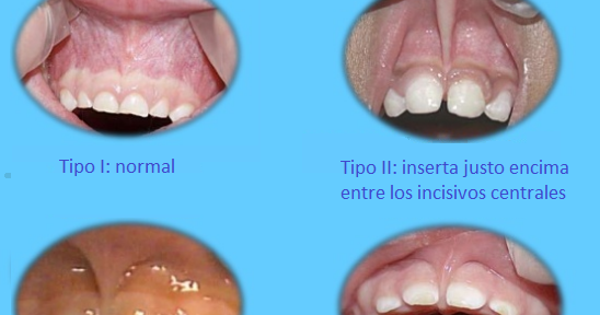 Supresión Cristo cliente frenillo labial superior recien nacido guión ...