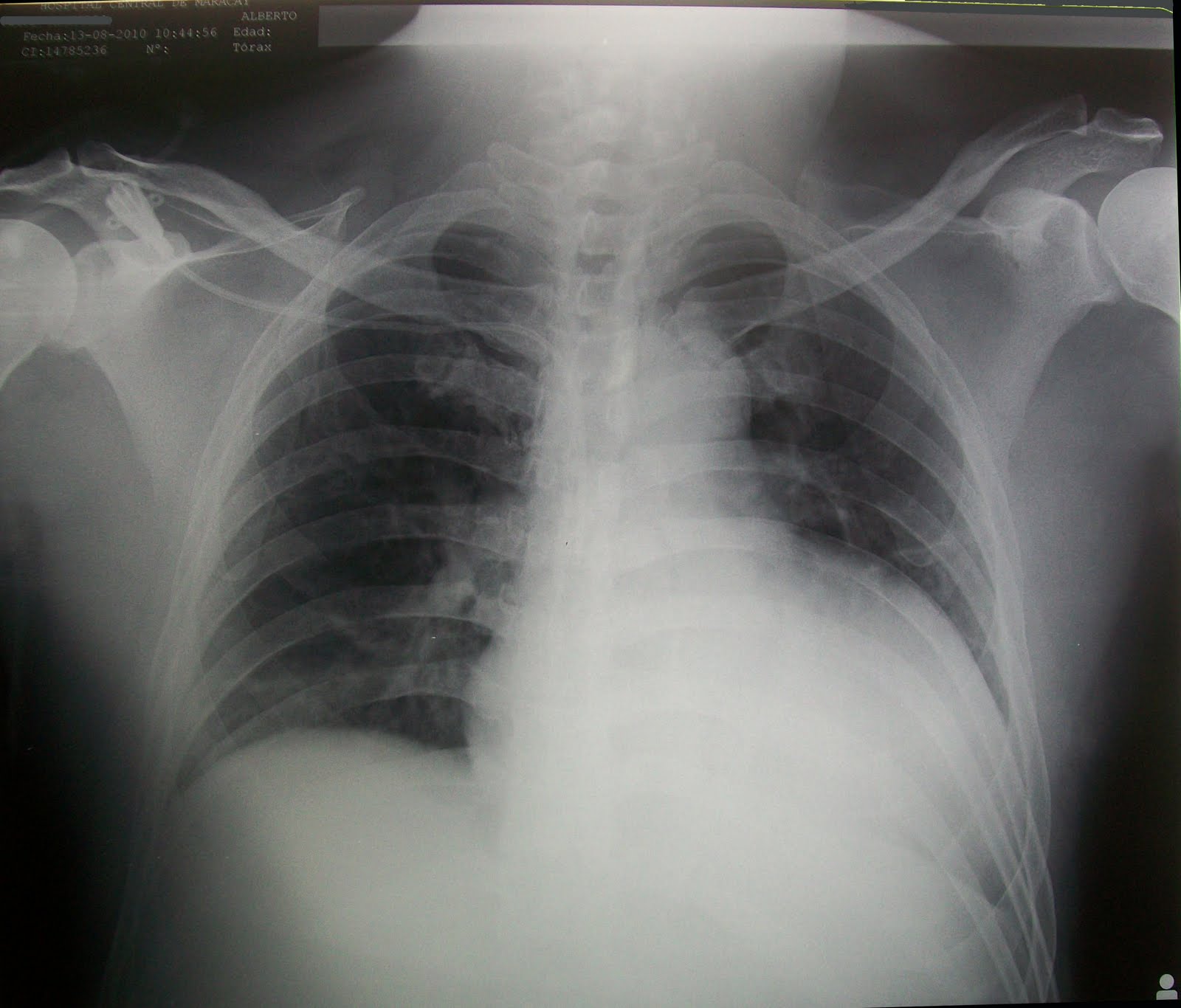 Sistemas Biológicos: Cardiomegalia - Imagens