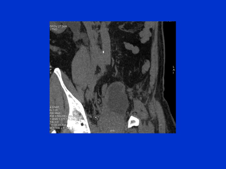 Kuching Urology古晉秘尿專科: Lower urinary tract symptoms LUTS and prostate ...