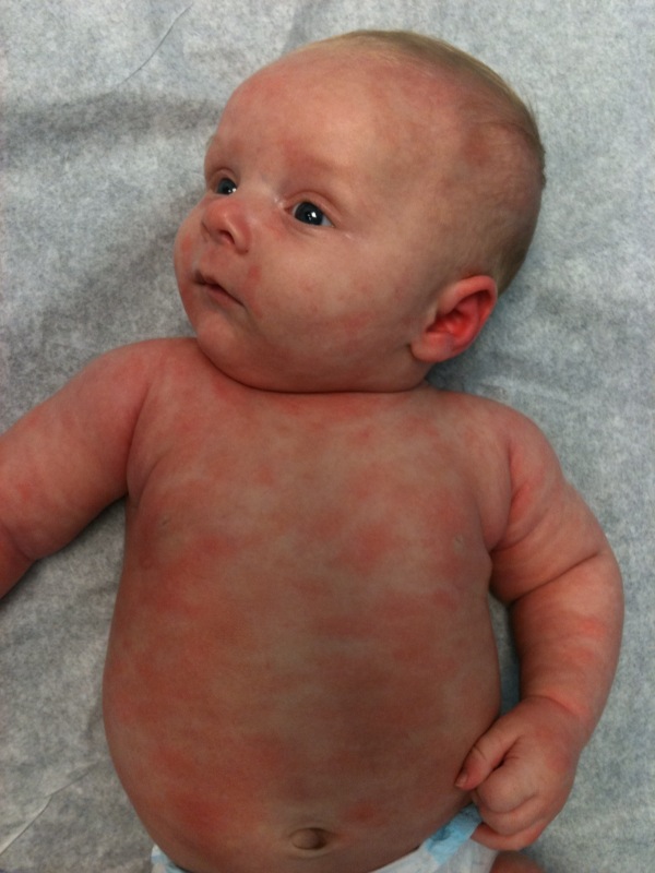 Michelle Arrose: A Teacher's Journey to Literary Success: Mastocytosis