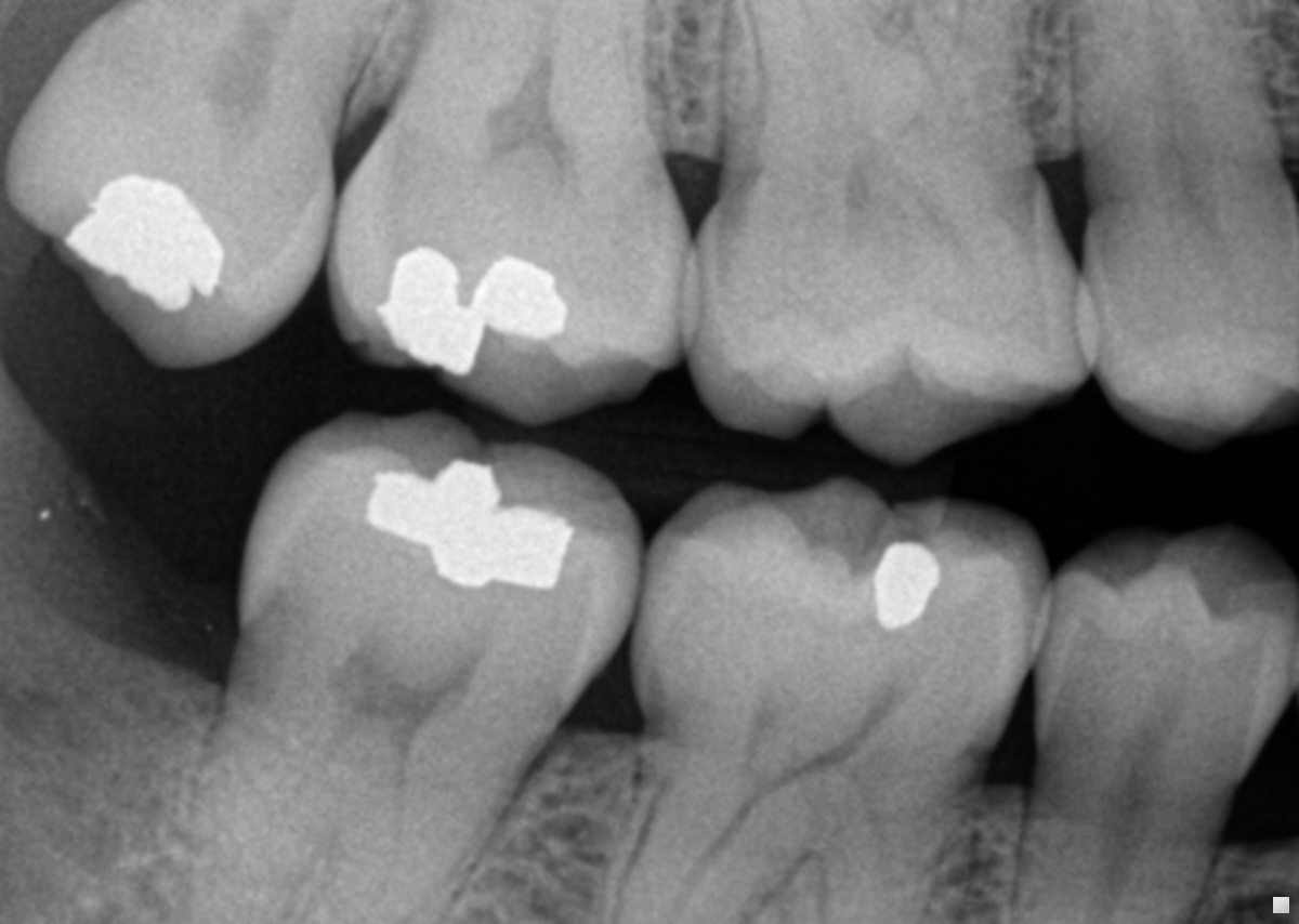 sweet tooth: distal decay on 2nd molars.