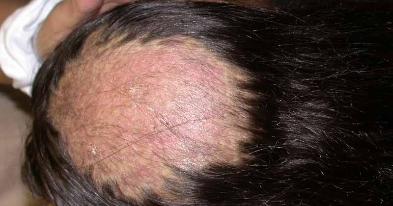 What Is Tinea Capitis? - Teroes