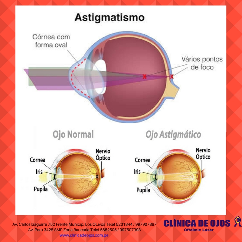 Clínica de Ojos Oftalmic Láser: Astigmatismo
