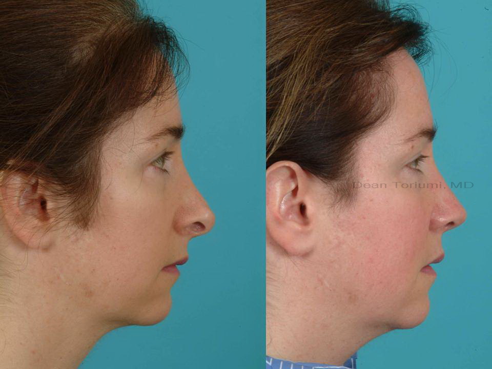 Dr. Dean Toriumi Reviews: Dean Toriumi Reviews: A secondary rhinoplasty ...