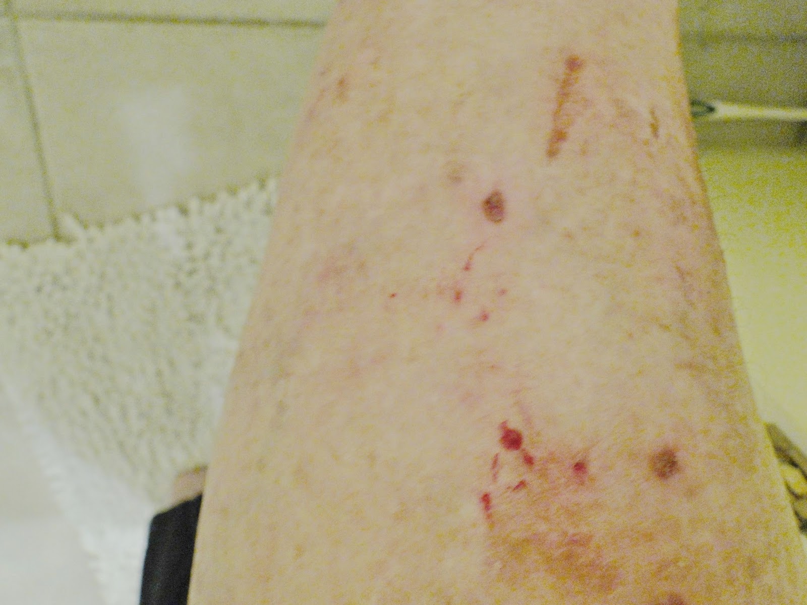 Leg Bites ALIEN ABDUCTIONS EFFECTS leg-bites-alien-abductions-effects