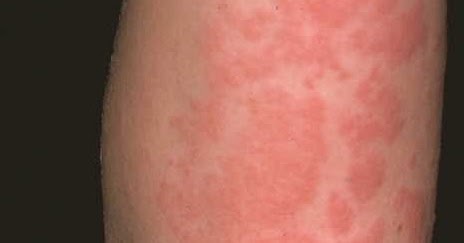 Lymphedema Skin Care: SKIN CONDITIONS AS AN ALLERGIC RESPONSE TO FOOD