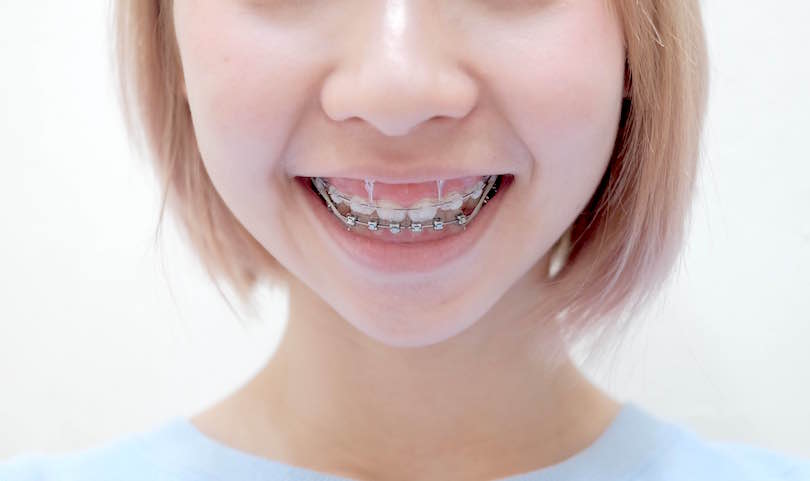 MY BRACES STORY #4: Wisdom Tooth | Chanwon.com | Travel & Beauty Blogger