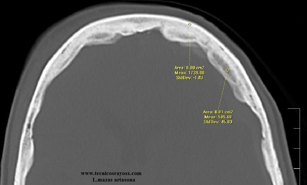 El Baúl Radiológico: COEFICIENTES DE ATENUACIÓN EN EL CRÁNEO (CT ...