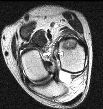 Radiology Channel: Anatomy of bundles of ACL and PCL.