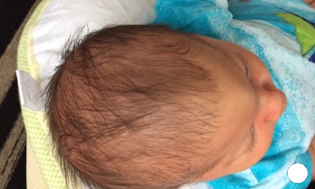 Nossa jornada com a craniossinostose: Trigonocefalia