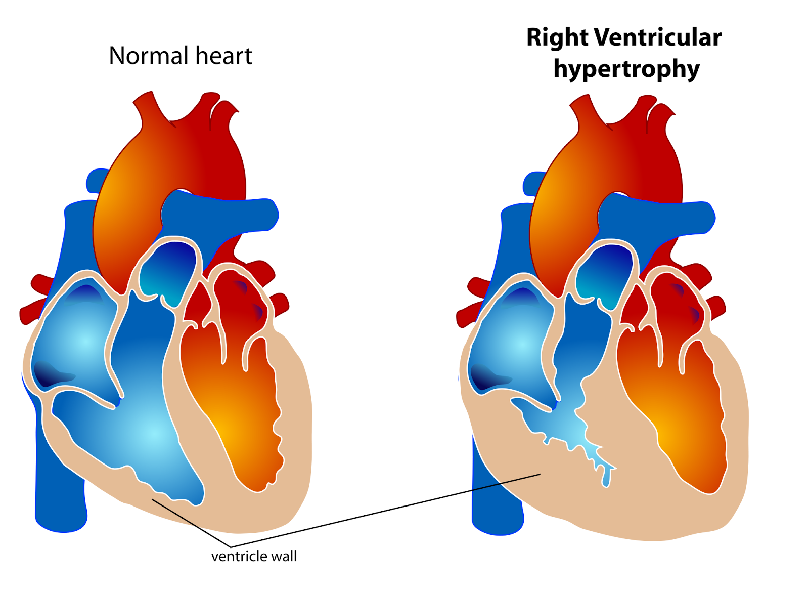 Right Ventricular Hyperthrophy | INA - ECG