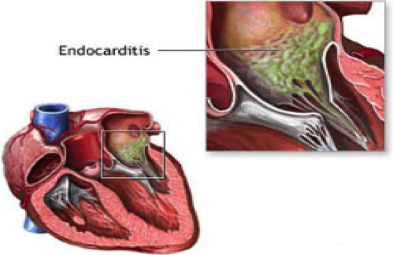 56: Endocarditis Bacteriana
