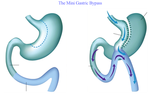 Obesity Solutions: Mini Gastric Bypass Surgery