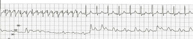 EKG Rhythm Strip Quiz 102