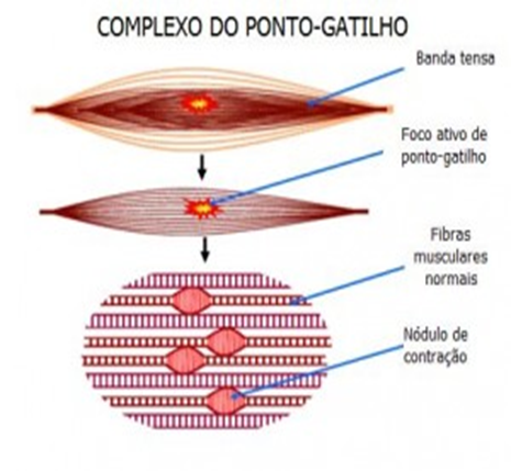 Trigger Points: Laser x TENS ~ RECURSOS TERAPÊUTICOS FÍSICOS