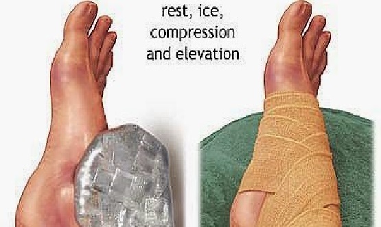 Jangan Di Urut Kaki yang Keseleo ==> Begini Cara Mudah Mengatasinya..!