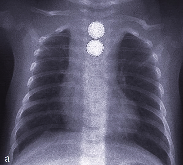 Revision Casos De Cirugia General: BATERIAS DE BOTÓN EN TRACTO ...