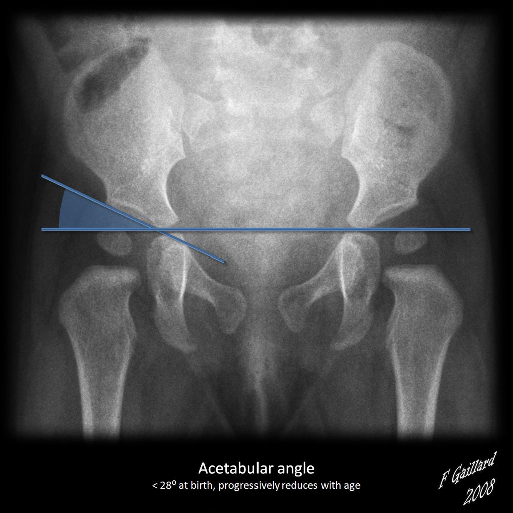 Hip dysplasia xray vs normal - oregonpere