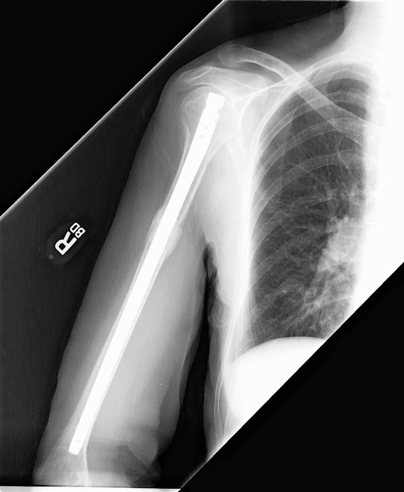 Shoulder and Elbow Surgery: Intramedullary nailing of bilateral ...