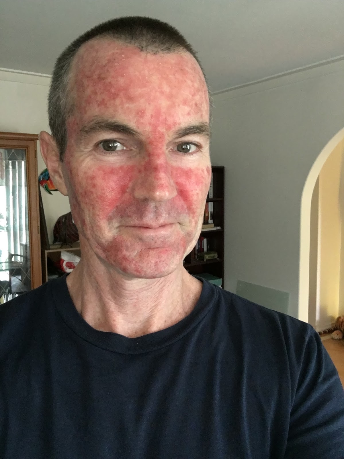 Efudix Treatment: March 2016