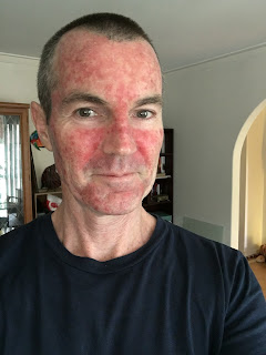 Efudix Treatment: Day 14 - two weeks