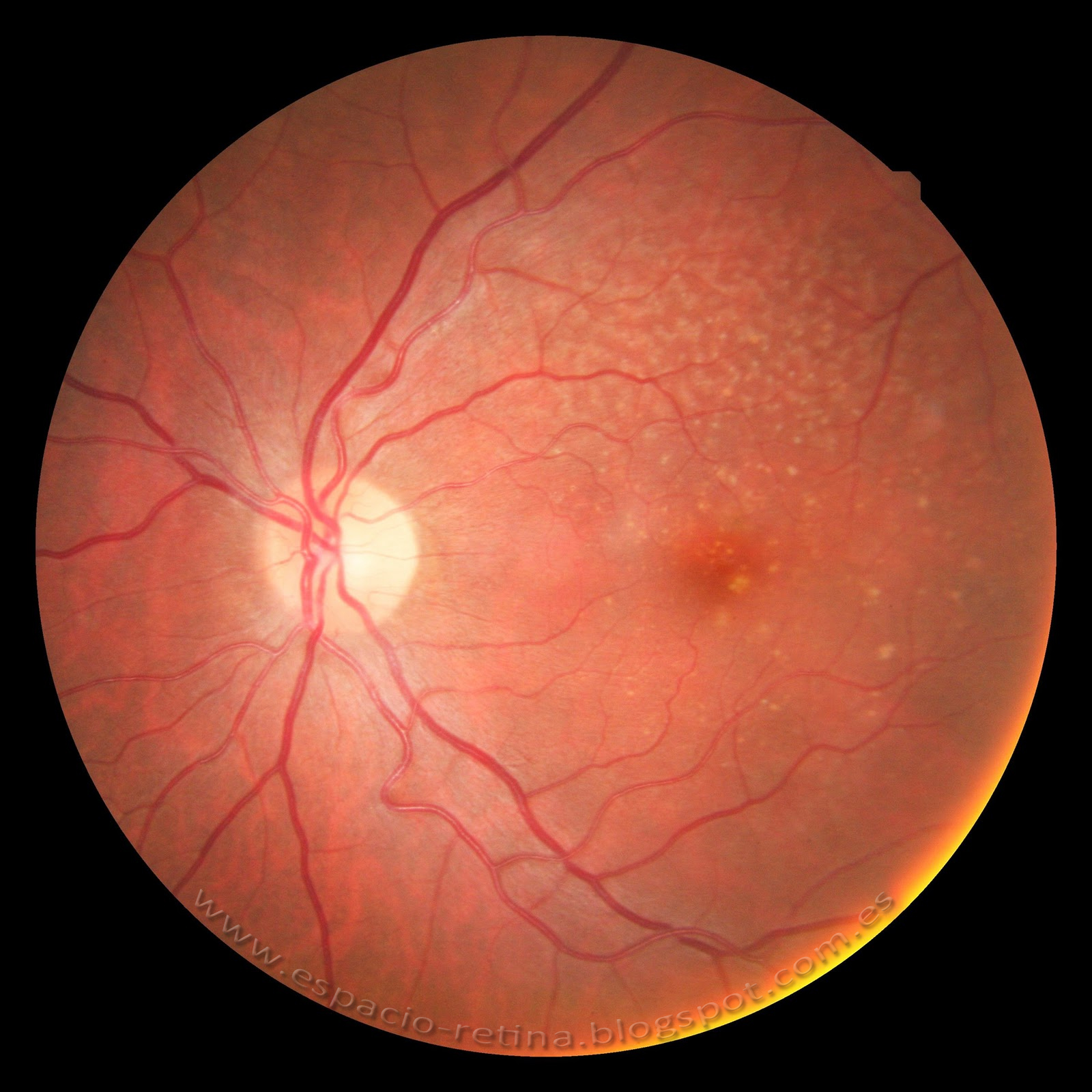 ESPACIO RETINA: Drusas.