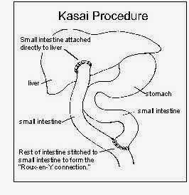 Laban ni Aloysius: Operation (KASAI PROCEDURE)