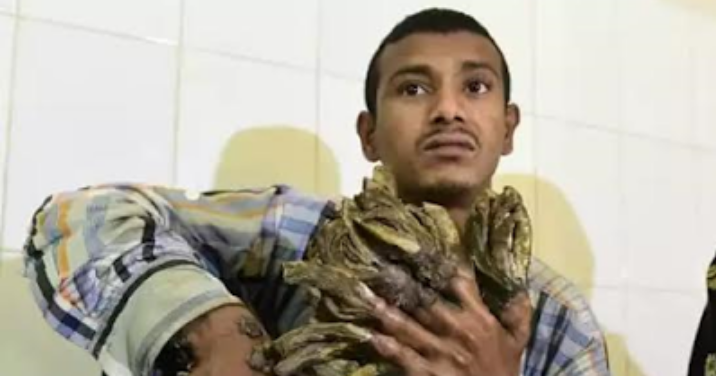 Welcome to Tiimsinfo: Photos: ‘Tree Man’ of Bangladesh finally ...