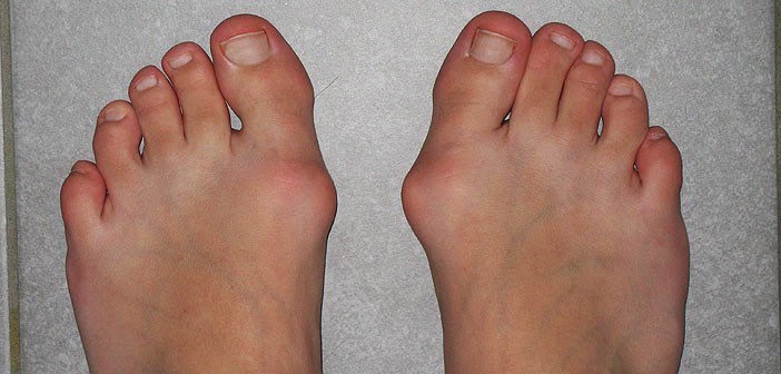 Kako se osloboditi čukljeva na nogama i riješiti se bolova u zglobovima ...